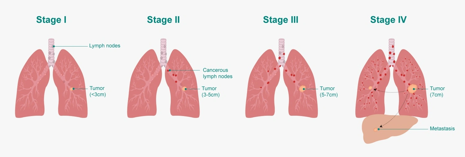 Signs and symptoms of lung cancer